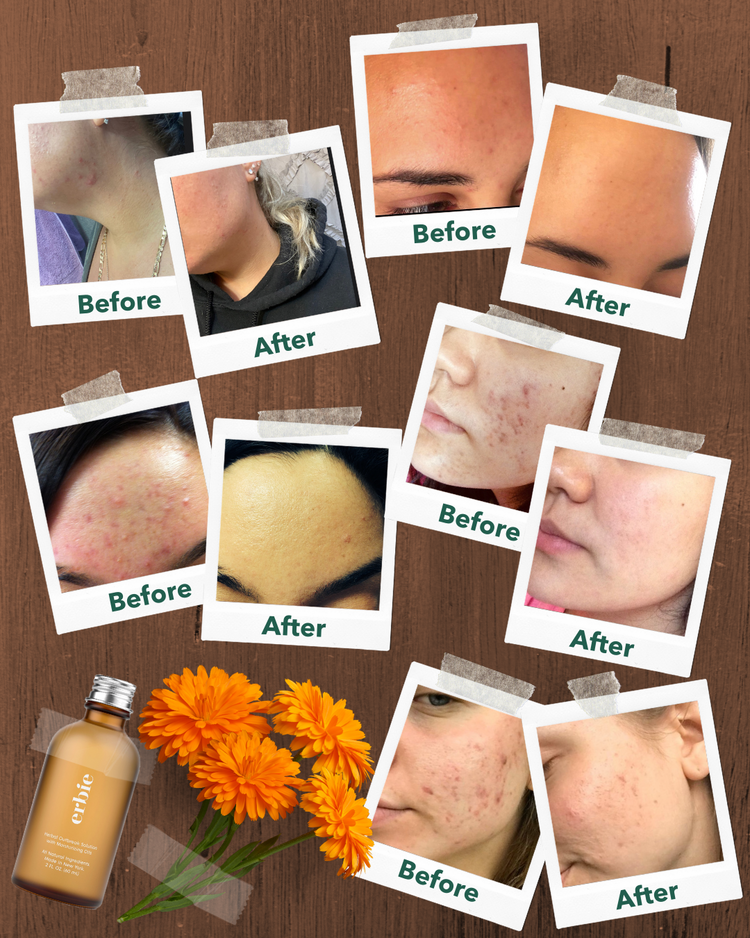 Erbie Herbal Outbreak Solution with Moisturizing Oils